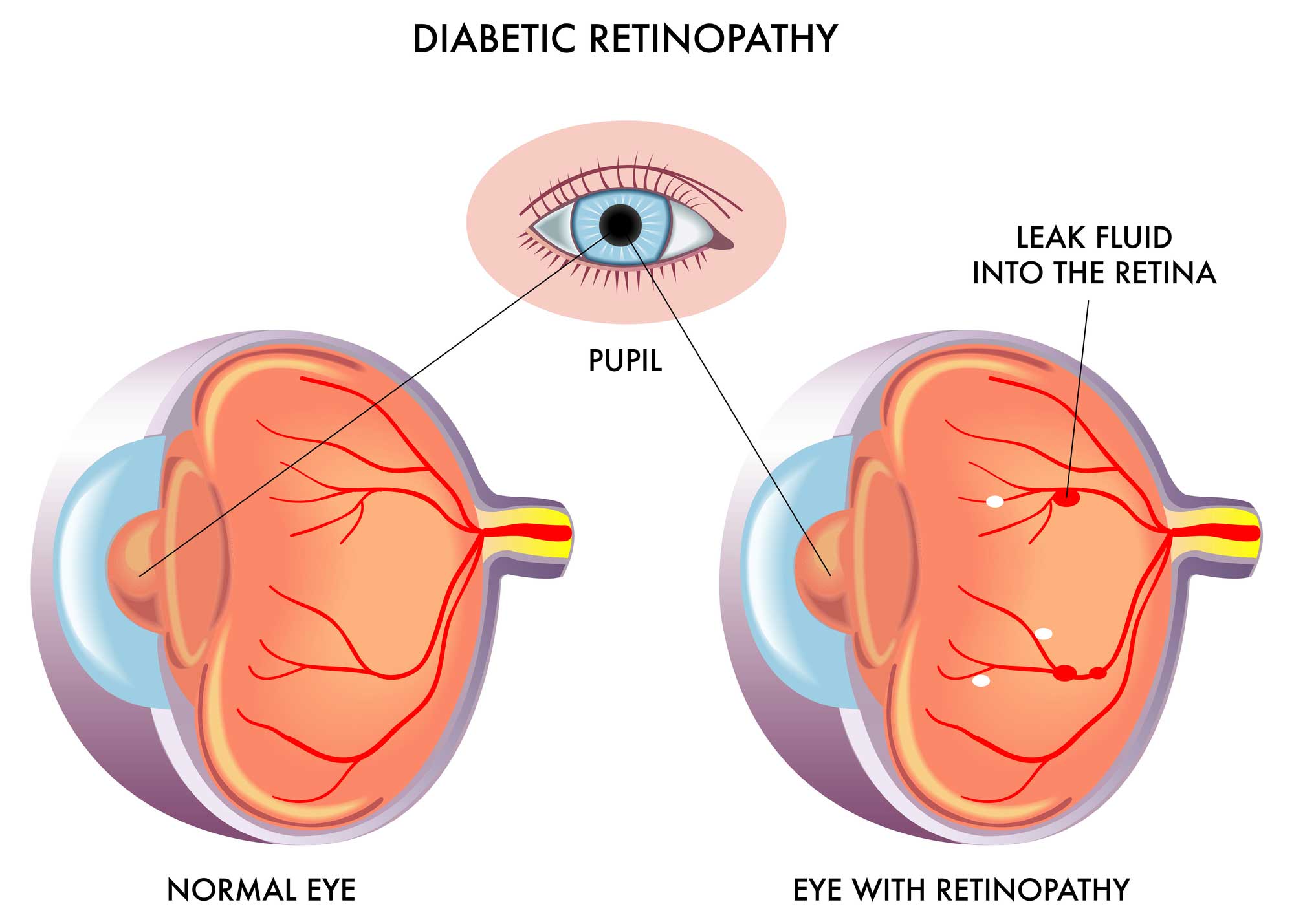 Eye Complications From Diabetes Heffington s