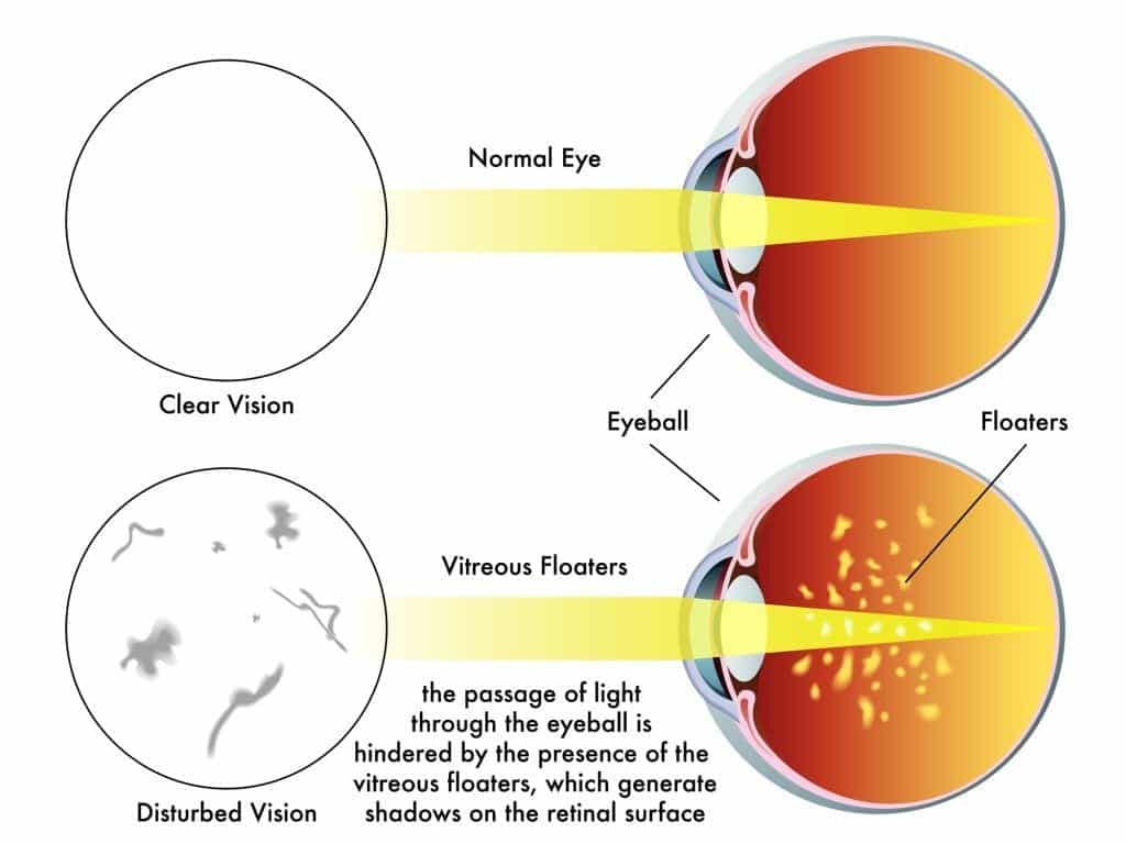 What Causes Eye Floaters Heffington s